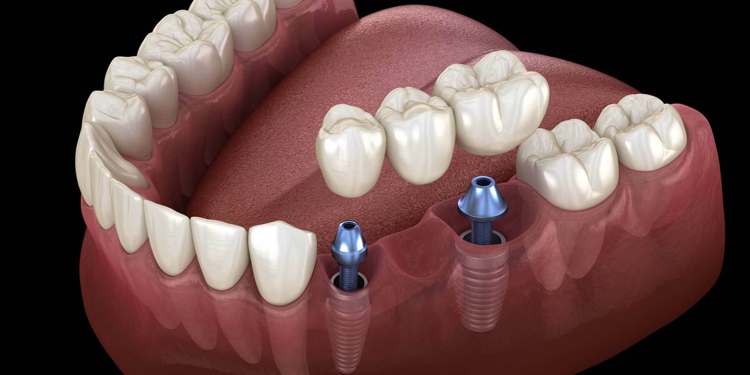 Dentures & Dental Implants