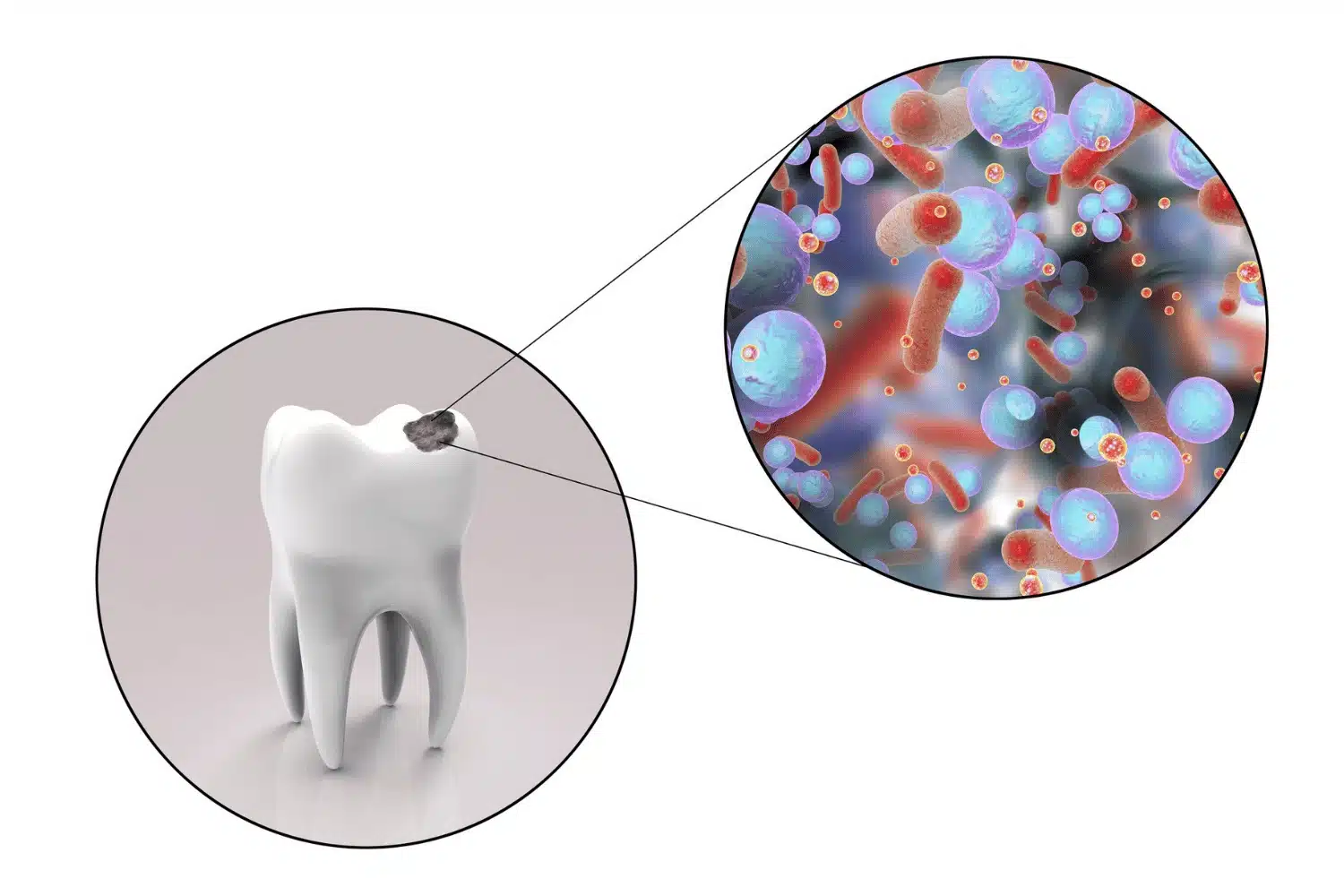 Tooth Decay Process Animation