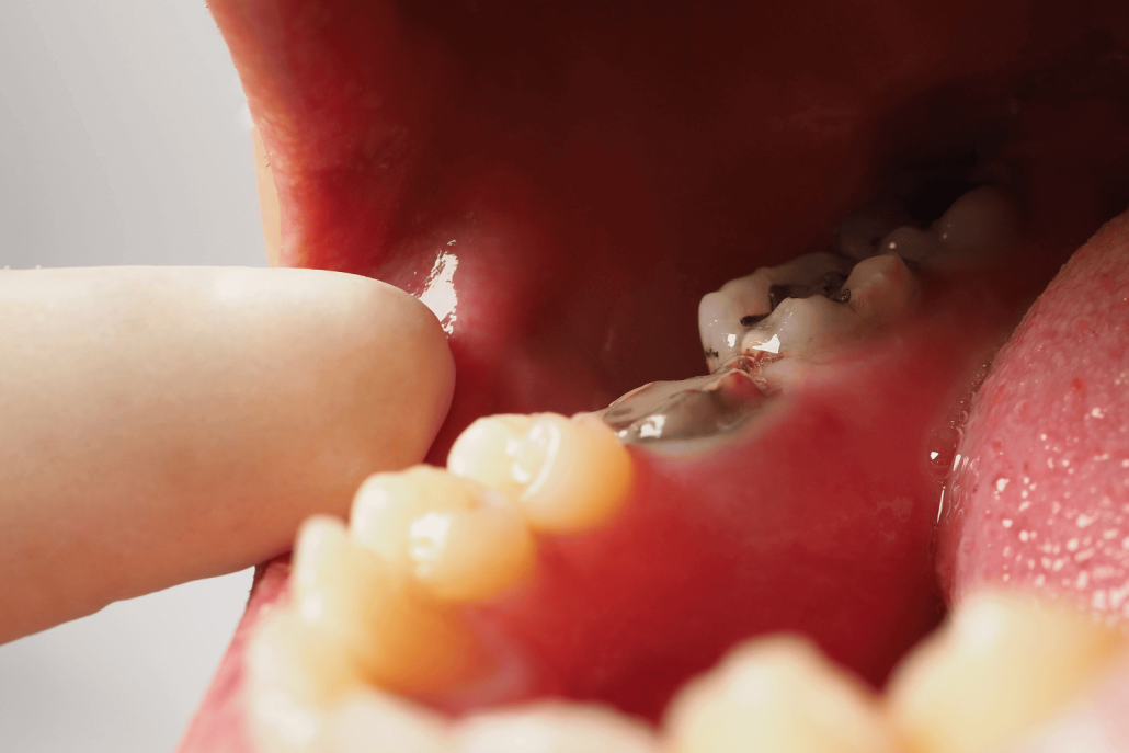 How An Infected Tooth Can Kill You: Essential Warning Signs To Know